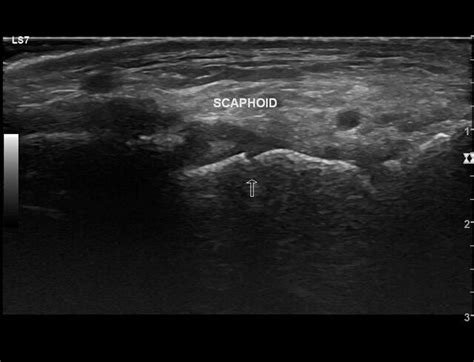 Radiopaedia Case Scaphoid Fracture Id 48724 Study 53734 Nc Commons