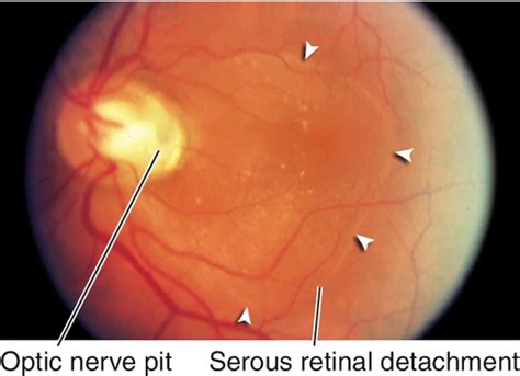 Optic Nerve And Glaucoma Clinical Gateclinical Gate