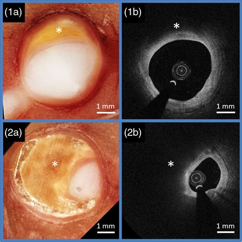 Automated A Line Coronary Plaque Classification Of Intravascular