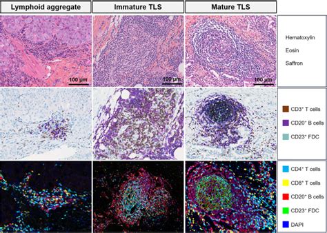 Tertiary Lymphoid Structures And Cancer Immunotherapy From Bench To