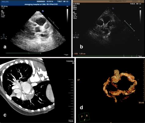 In Patient 1 Echo Showed The Thrombus Formed In The Lad And The Lumen