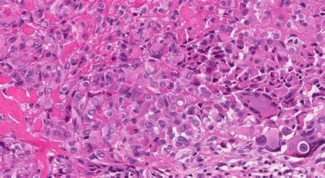 Epithelioid Sarcoma Mypathologyreport