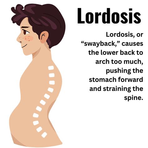The Differences Between Scoliosis Kyphosis And Lordosis — Brace Direct