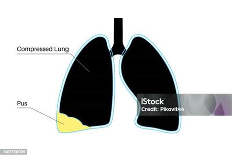 Pyothorax Pleural Empyema Stock Illustration Download Image Now Activity Anatomy Bacterium
