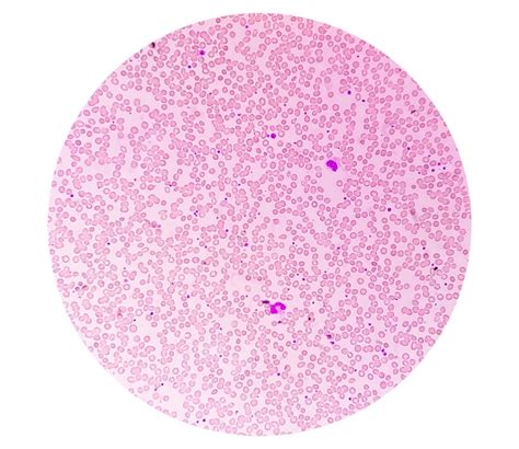 Fotomicrografía Del Rasgo De Hemoglobina D O Hemoglobina D Punjab Con
