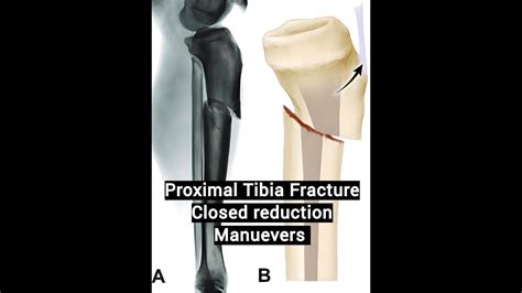 Proximal Tibia Fractures—closed Reduction Maneuvers Youtube