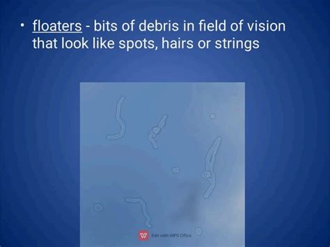 Retinal Detachment Types Of Retinal Detachment Ppt