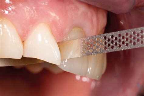Diamond Ipr Strips — Smile Stream Solutions
