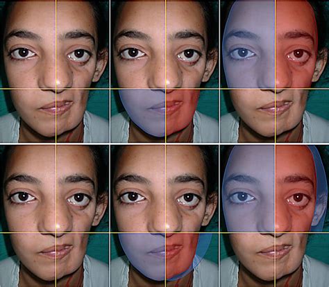 Computerized Photogrammetric Facial Symmetry Analysis With Anatomical