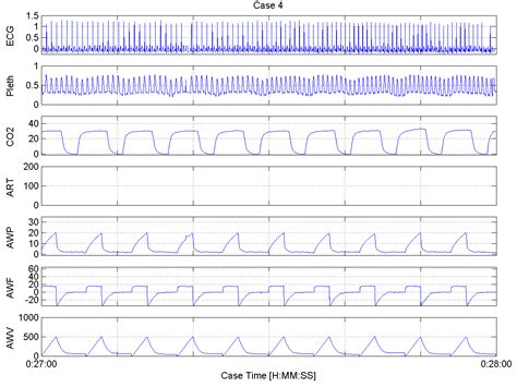Case 4 Waveform Plots 60 Second Plots