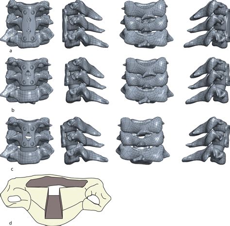 Finite Element Model Of The Cervical Spine Under Three Types Of Download Scientific Diagram