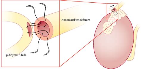 Epididymal Cyst Diagram