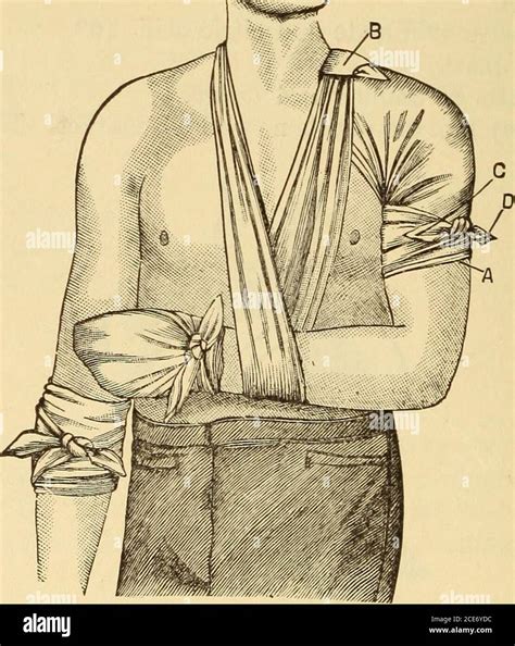 Triangular Bandage Techniques