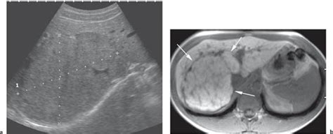 Liver Differential Diagnosis Of Hepatic Diseases Radiology Key Liver Differential Diagnosis Of Hepatic Diseases Radiology Key