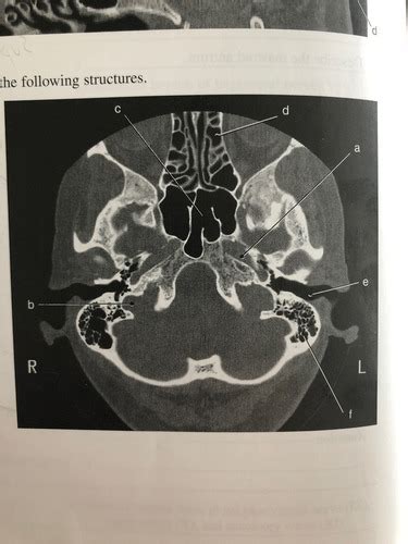 Axial Ct Temporal Bone Diagram Quizlet
