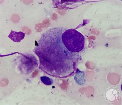 Megakaryocyte In Mds With Isolated Del 5q