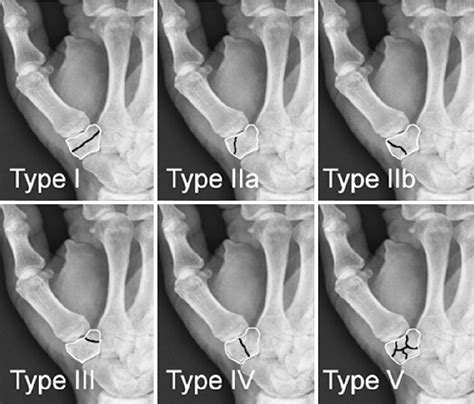 A Dislocated Thumb At Mark Bateman Blog