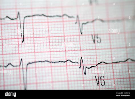 An Electrocardiograph Ecg A Chart That Draws The Electricity Of The