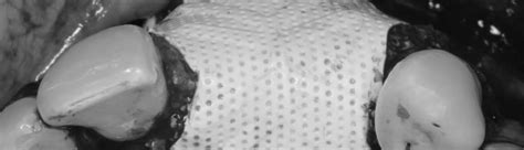 Horizontal And Vertical Gbr Ridge Augmentation In 5 Videos Jovanovic And Simion Gide Dental