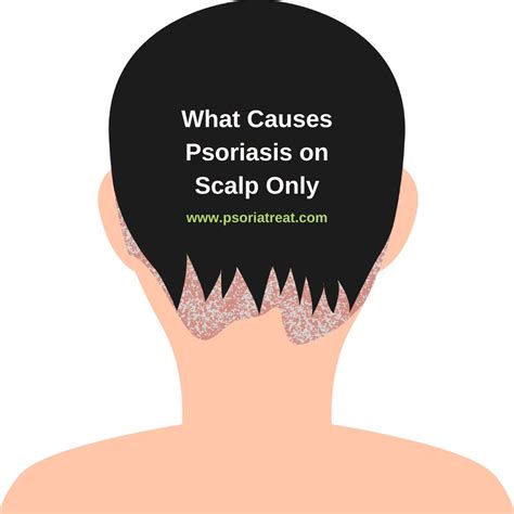 What Causes Psoriasis On Scalp Only Dr Rajendra Sonawane