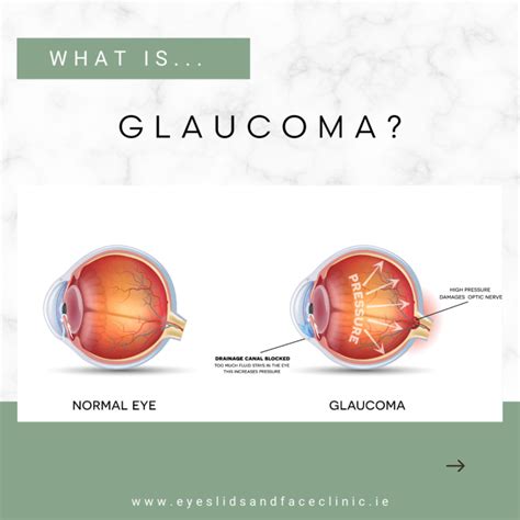 Understanding Glaucoma Eyes Lids And Face Clinic