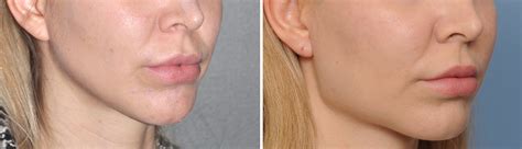 Concepts In Female Jawline Augmentation Explore Plastic Surgery