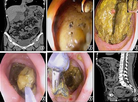 Endoscopic Fenestration Combined With Catheterization In The Treatment