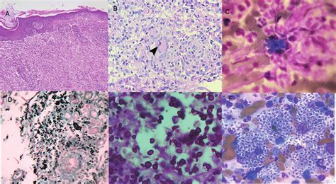 Histopathologic And Cytopathologic Diagnosis A Skin Section With