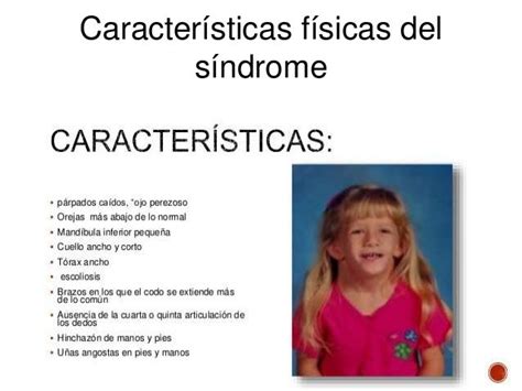 Sindrome De Turner