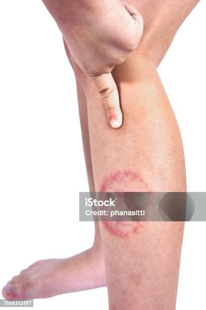 Ringworm Infectie Of Tinea Corporis Op De Huid Geïsoleerd Op Witte