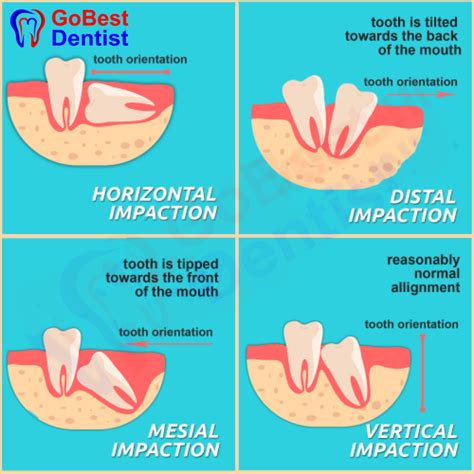 Normal Wisdom Tooth Extraction Wisdom Tooth Extractions Chesapeake Va
