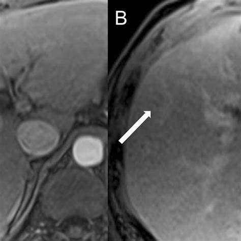 Example Of An Intrahepatic Cholangiocarcinoma Icca With A Download Scientific Diagram