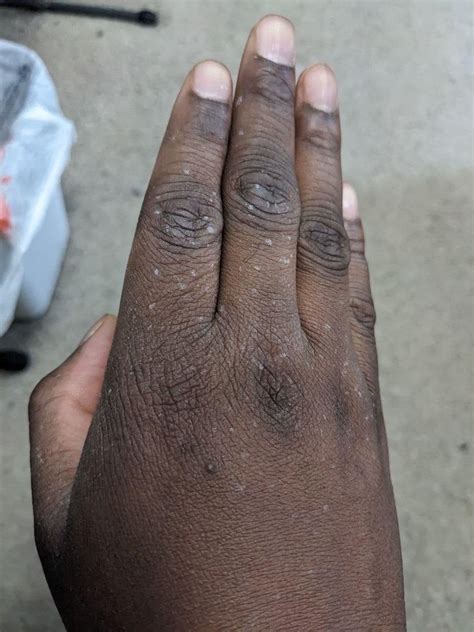What Are These White Dots On My Hand They Sometimes Are There In The