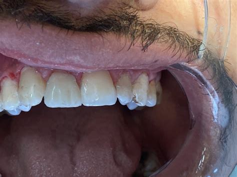 Smile Rehabilitation Reshaping Partial Veneer And Class V Caries