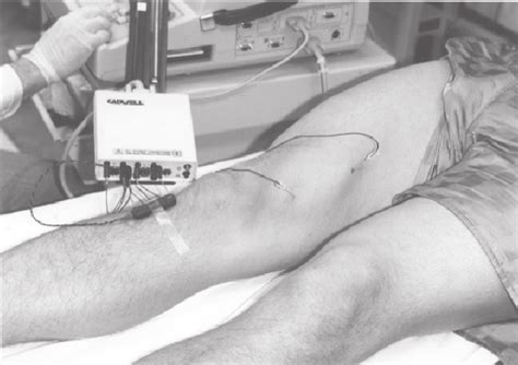 Electrode Placements Into The Vm Muscle Vmo Placement Is 3 Cm Medial