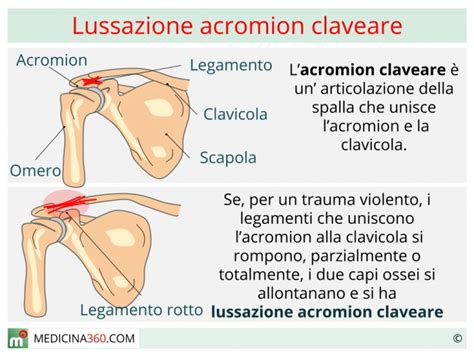 Acromion Fracture Healing Time Acromion Fracture Diagnosis Treatment And Recovery Time