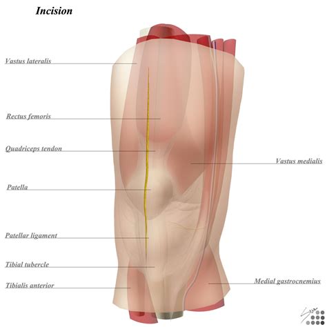 Knee Medial Parapatellar Approach Approaches Orthobullets
