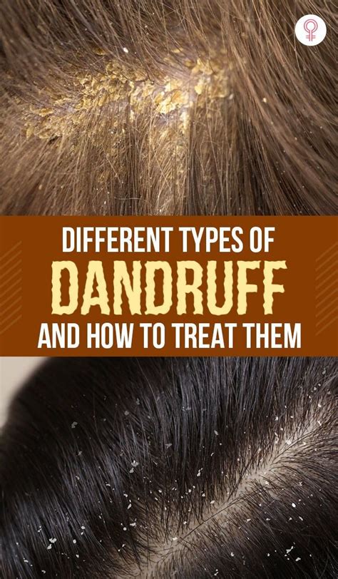 Different Types Of Dandruff And How To Treat Them How Can This
