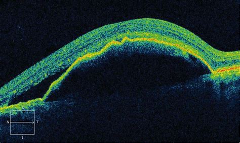 Retinal Tear Oct