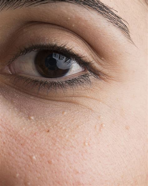 Milia Skin Solution Hamilton