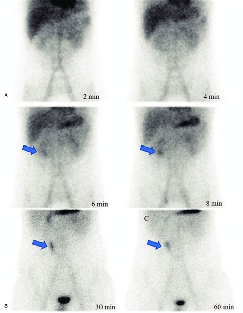 99m Technetium Pertechnetate Scintigraphy Show A Subtle Focus Of
