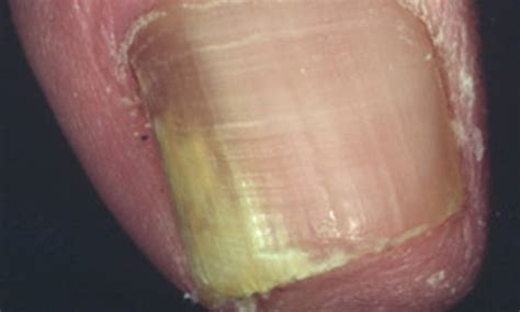 Fungal Infection On Nails