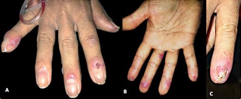 Figure 1 From Case Chilblain Lupus With Nail Involvement A Case Report Cid 2 Semantic Scholar