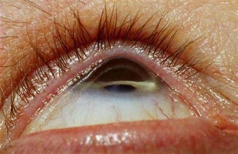 Best Images About Eye Stuff On Pinterest Wilson S Disease Medical And Eyes