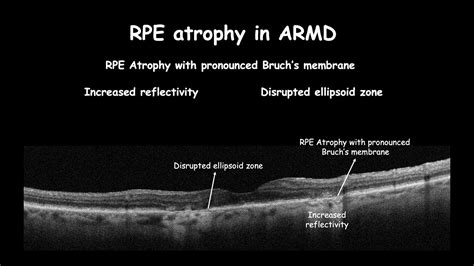 Rpe Dropout On Oct Ophthalmology Dx Whats Behind This Bilateral