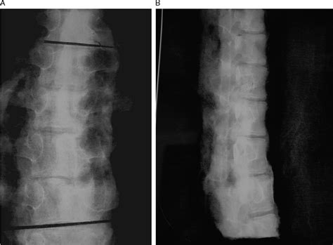 The Anteroposterior A And Lateral B Radiographs Demonstrate Fusion
