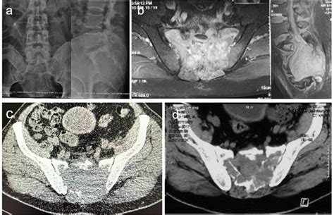 Preoperative Radiographic Examinations A B Preoperative X Ray And Mri Download Scientific
