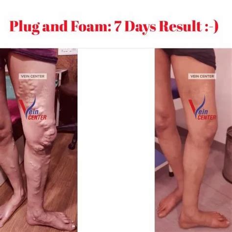 Varicose Veins Laser Treatment At ₹ 175000 In Mumbai Id 21091317291