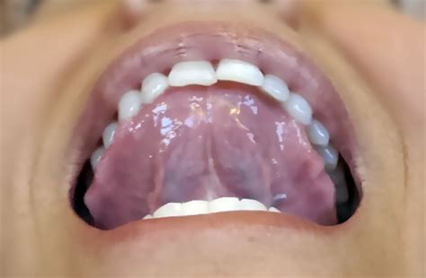 Where Should Your Tongue Rest When Your Mouth Is Closed Or Sleeping