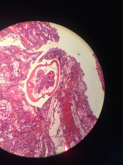 Pathology Outlines Enterobius Vermicularis